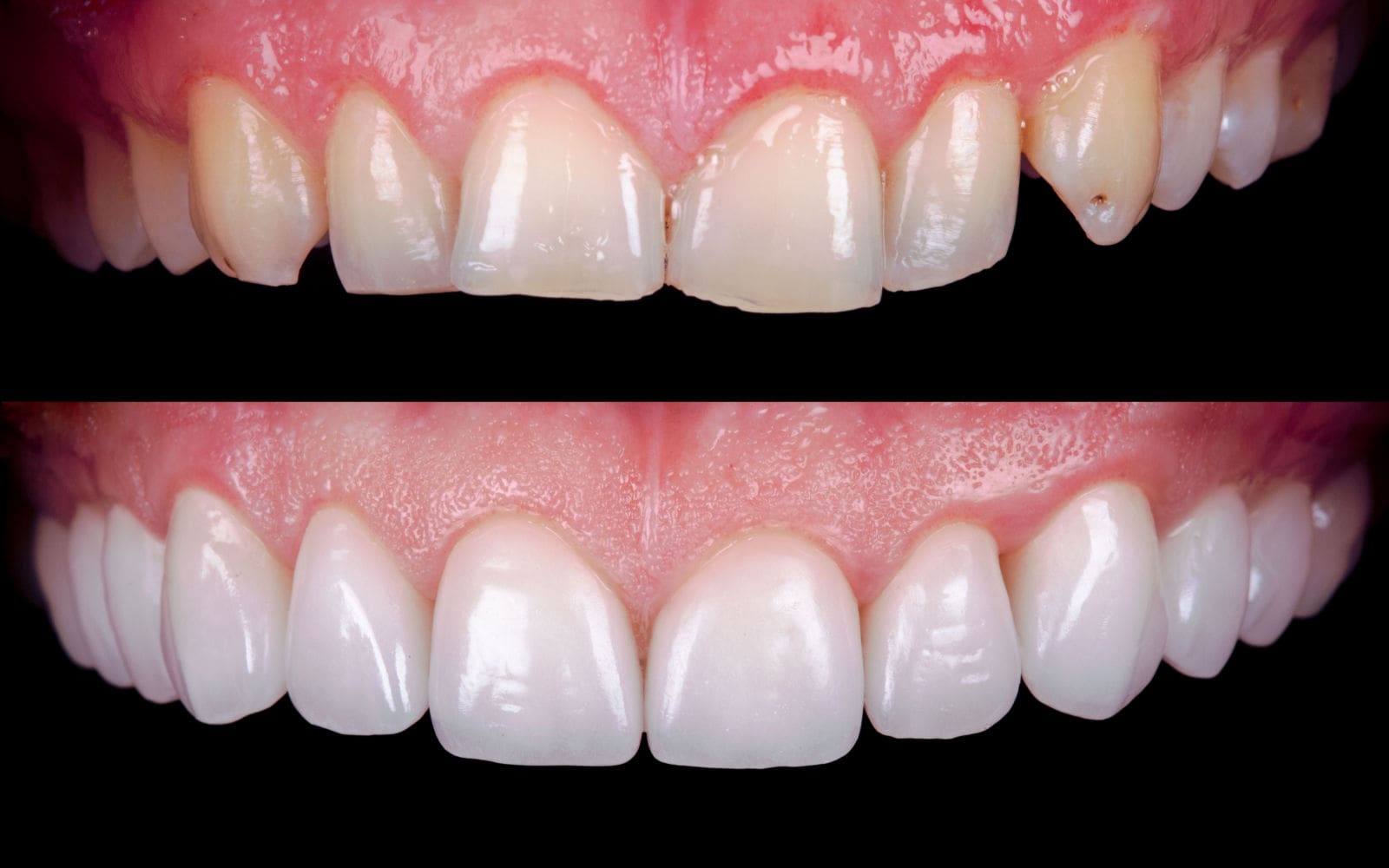 - How Direct Dental Restorations Can Address Dental Trauma ...